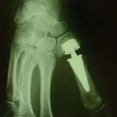 Prothèse trapézométacarpienne : traitement rhizarthrose - Dr Thomsen